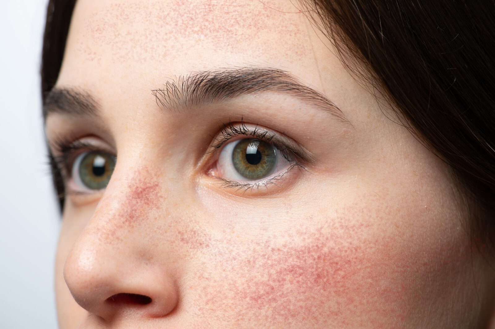 Rosy Red Cheeks: 17 Causes & Treatments | The Rosacea Method