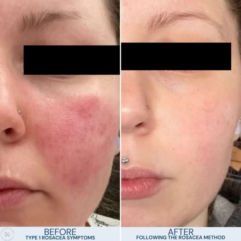 Type 1 Rosacea - Mastering ETR Treatments | The Rosacea Method