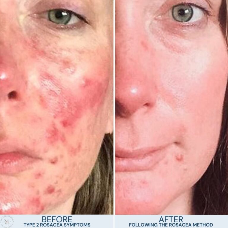 Type 2 Papulopustular Rosacea vs Acne Challenge | The Rosacea Method