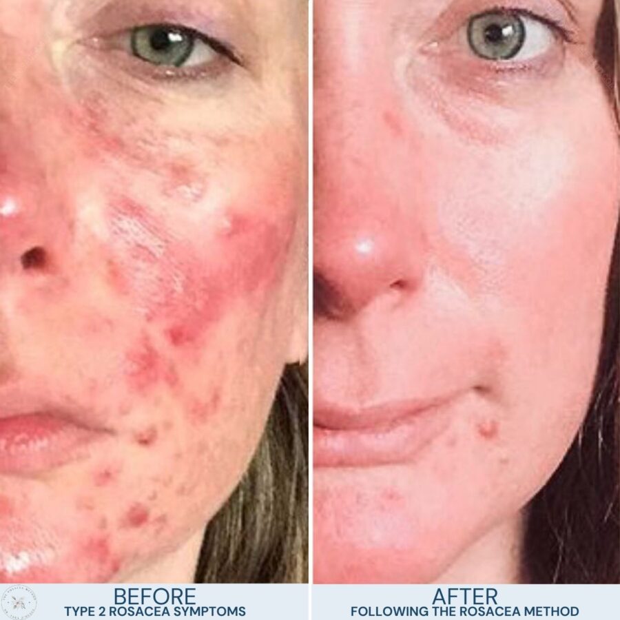 Type 2 Papulopustular Rosacea vs Acne Challenge | The Rosacea Method