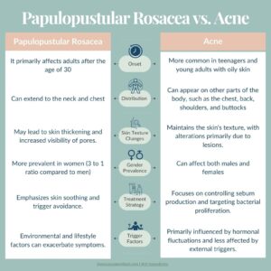 Type 2 Papulopustular Rosacea vs Acne Challenge | The Rosacea Method