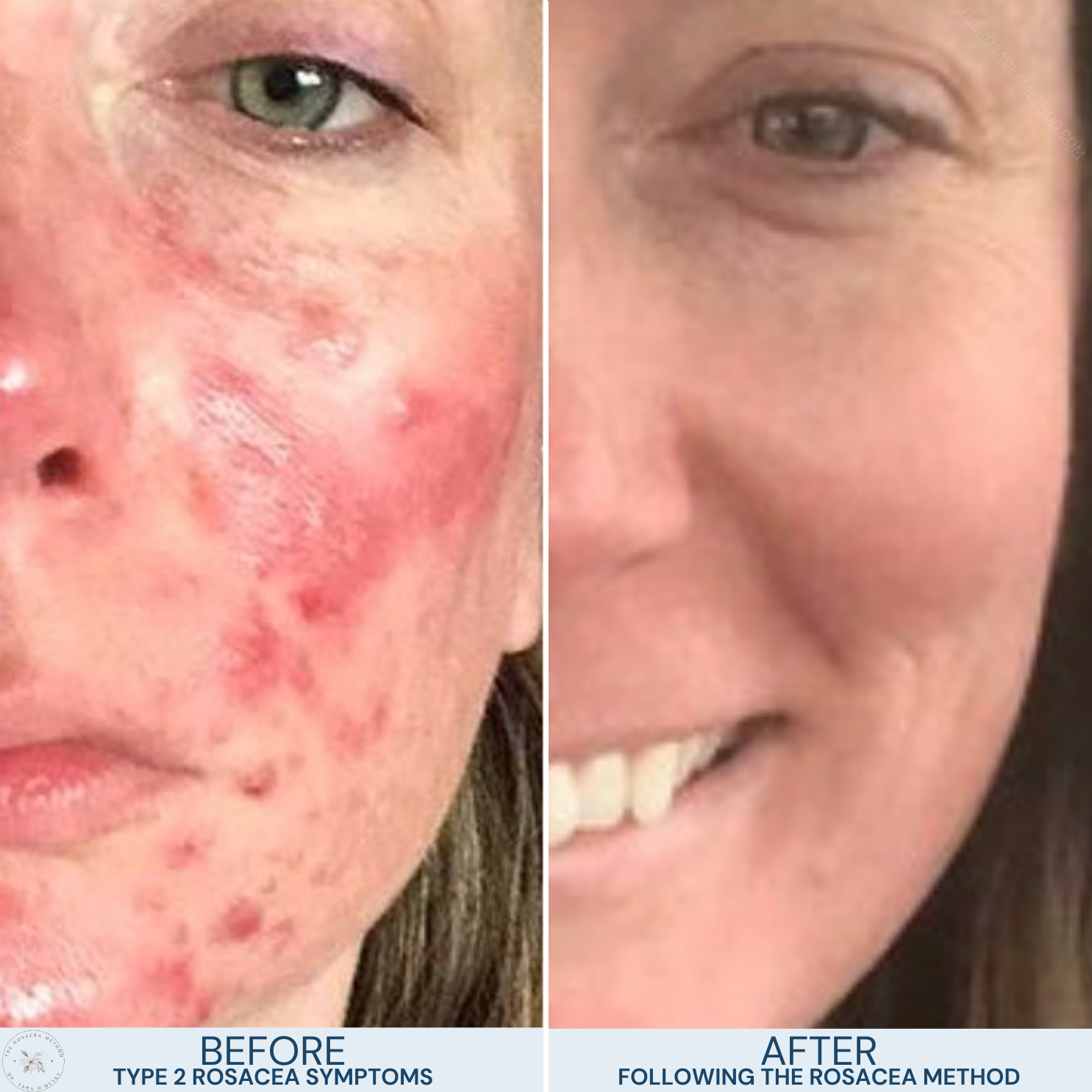 Natural Healing for Rosacea: Best Science-Backed Treatment & #1 Results ...